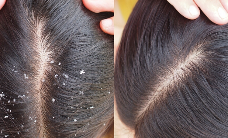 What does Ayurveda say about Dandruff and what is the solution? – Sesa Care